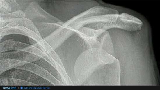 Glenohumeral Joint Instability: Literature Review on Management of a ...