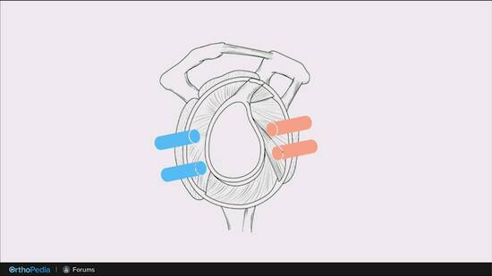 Advancements in Soft-tissue Fixation for Anterior Glenohumeral Joint ...