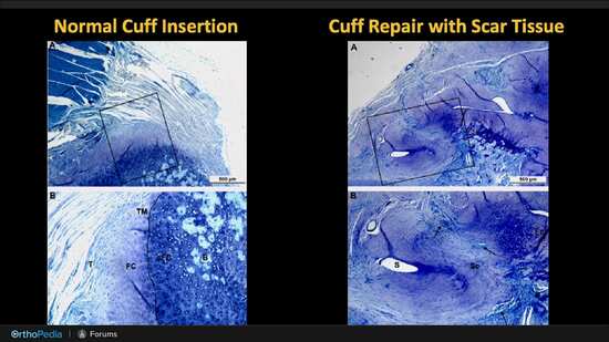 OTIF: Full-Thickness Rotator Cuff Repair With Interpositional Graft ...