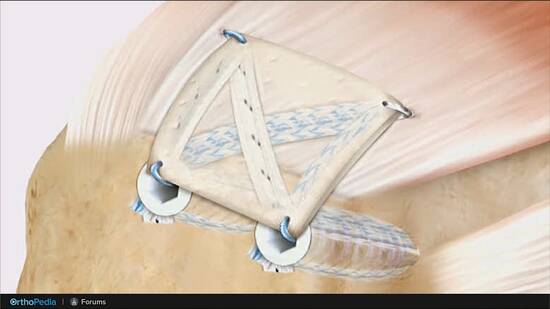 OTIF: Rotator Cuff Augmentation With Dermal Allograft : OrthoPedia