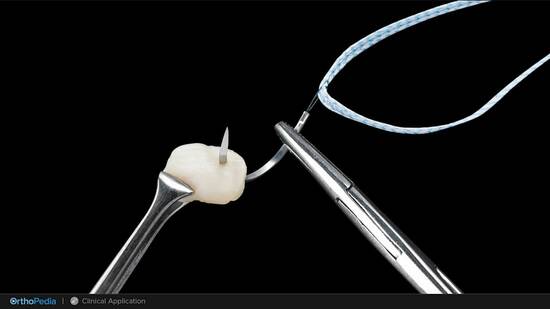 Posterosuperior Rotator Cuff Tears: RCR Using the Knotless SwiveLock ...