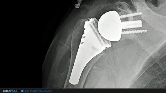 Rotator Cuff Tears: Literature Review on Reverse Total Shoulder ...