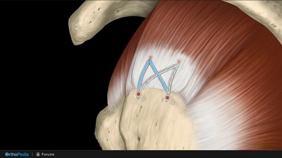 Sports Medicine Fellowship Forum: Knotless, Double-Row Rotator Cuff ...
