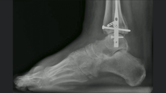 Innovations in Trauma Surgery, Part 3: Ankle Innovations in Trauma ...