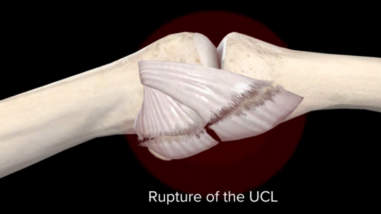 Thumb Sprains : OrthoPedia Patient