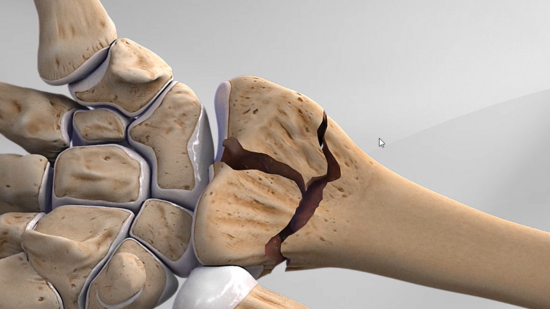Wrist Fractures : OrthoPedia Patient