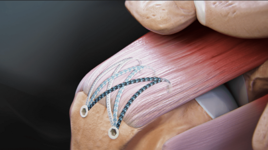 Rotator Cuff Tears: Double-Row Rotator Cuff Repair Animation ...