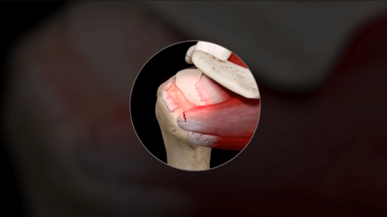 Rotator Cuff Tears: Overview : OrthoPedia Patient