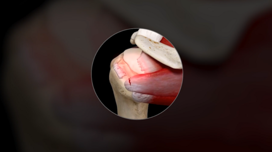 Rotator Cuff Tears : OrthoPedia Patient