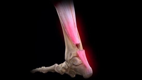 Achilles Tendon Tears : OrthoPedia Patient