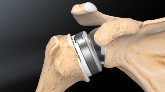 Shoulder Arthritis: Reverse Total Shoulder Replacement Animation ...