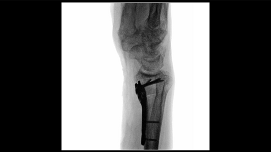 Distal Radius Fractures: Fixation With the Sterile Distal Radius ...