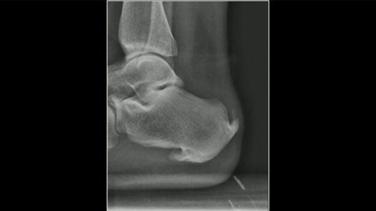 Foot and Ankle MIS Course: MIS Achilles SpeedBridge™ Repair Implant ...