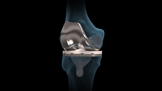 Knee Arthritis: Total Knee Replacement Animation : OrthoPedia Patient
