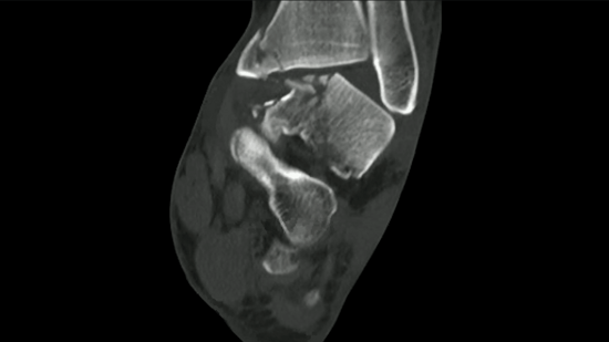 Open Reduction and Internal Fixation (ORIF) Approach Pearls for Pilon ...