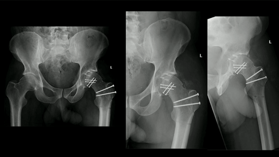 Treatment Approaches for Femoral Head and Neck ORIF : OrthoPedia