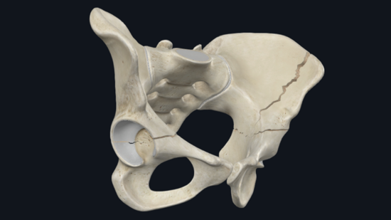 Acetabular Fractures : OrthoPedia
