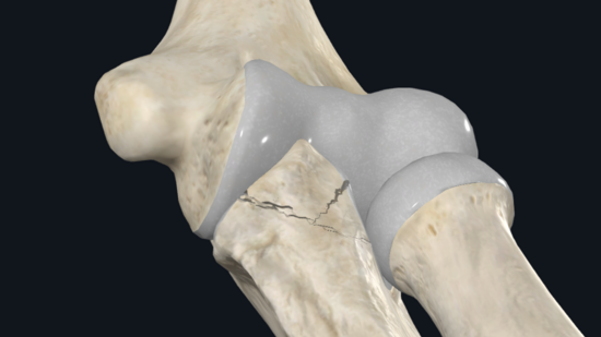 Coronoid Fractures : OrthoPedia