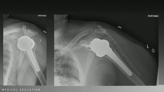 Approaching Fellowship: Shoulder and Humerus ORIF Approach Pearls ...