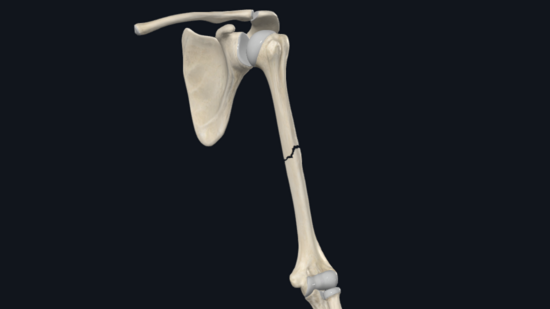 Humeral Shaft Fractures : OrthoPedia