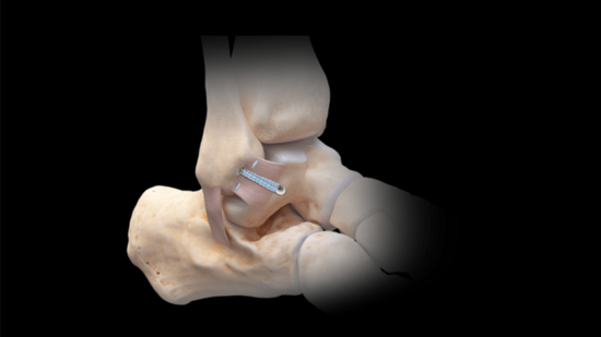 Chronic Ankle Sprains (Lateral Ankle Instability): Broström Repair With ...