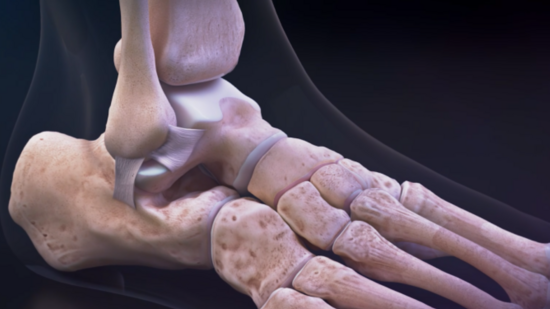 Chronic Ankle Sprains (Lateral Ankle Instability) : OrthoPedia Patient