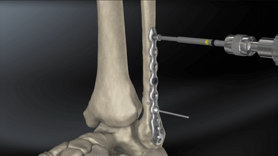 Ankle Fractures: Ankle Fracture Management Animation : OrthoPedia Patient