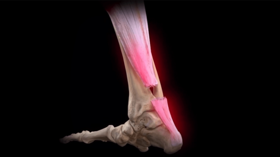 Achilles Tendon Tears: Treatment Options : OrthoPedia Patient