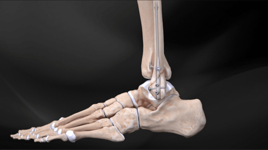 Ankle Fractures: Fixing the Fracture With a Bone Nail and Screws ...