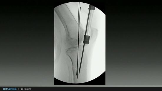 On-Call With Arthrex Trauma: Challenges and Solutions for Tibial Shaft ...