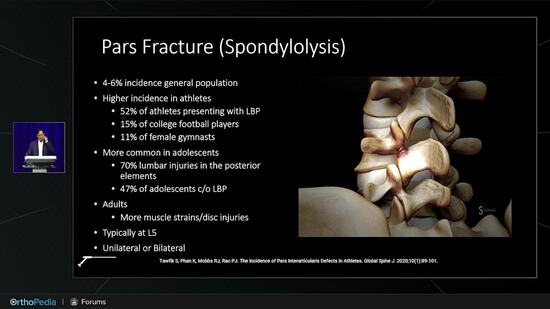 Spine Evolutions: Sports Injuries—Pars Repairs : OrthoPedia