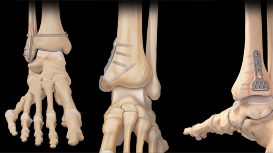 Ankle Fractures: Treatment Options : OrthoPedia Patient