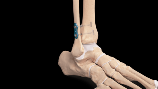 High Ankle Sprains: Syndesmosis Repair Using Suture Implant Animation ...