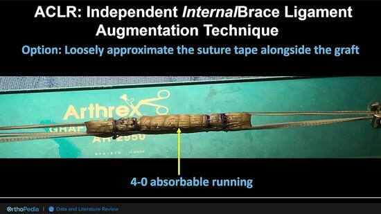 Anterior Cruciate Ligament (ACL) Injuries: Literature Review on Suture ...