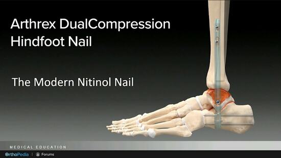 The DualCompression Hindfoot Nail for Tibiotalocalcaneal Fusion ...