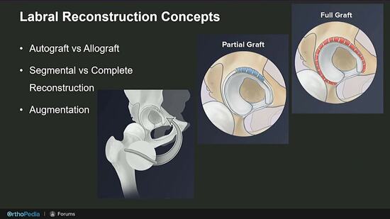 Hip Labral Reconstruction: Evolution to Labral Reconstruction : OrthoPedia