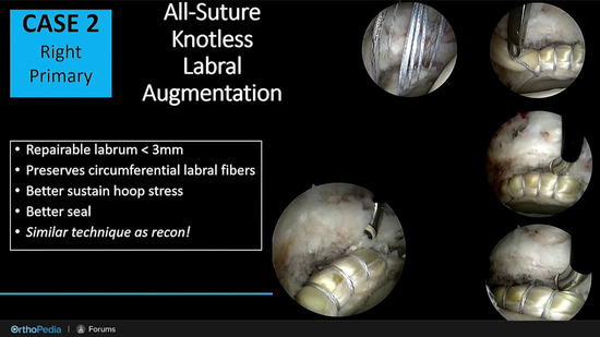 Hip Labral Reconstruction: Role of Hip Labral Augmentation : OrthoPedia