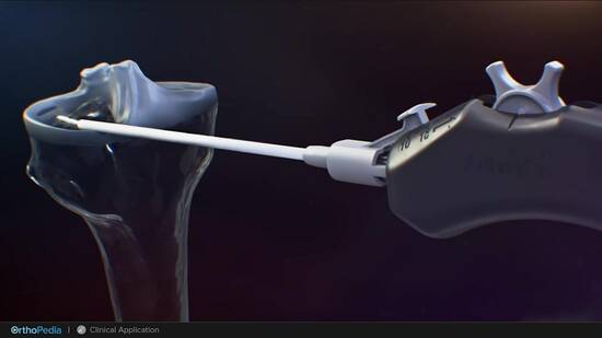 Meniscal Pathologies: All-Inside Medial Meniscus Repair Using the ...