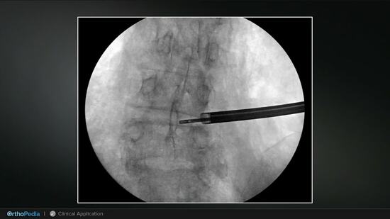 Disc Disease: Endoscopic Approach to Transforaminal Discectomy : OrthoPedia