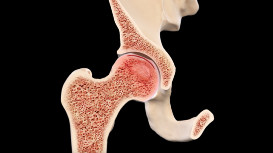 Hip Avascular Necrosis (AVN) : OrthoPedia Patient