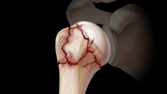 Upper Arm Bone Fractures (Proximal Humerus Fractures) : OrthoPedia Patient