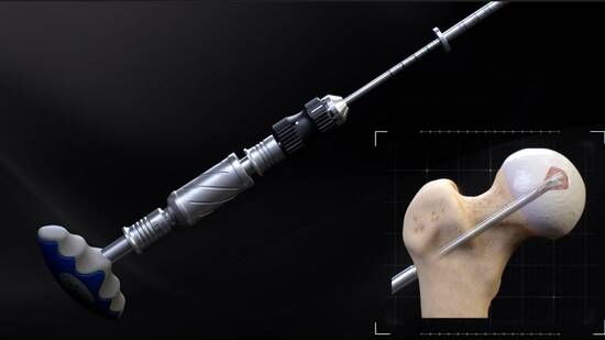 Hip Avascular Necrosis (AVN): AVN Treatment With an Expandable Reamer ...