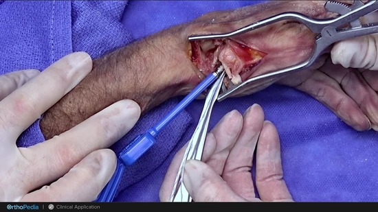 Thumb Carpometacarpal (CMC) Arthritis: CMC Suspensionplasty With the ...