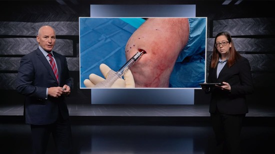 Quad ACL: Technique Play-by-Play : OrthoPedia