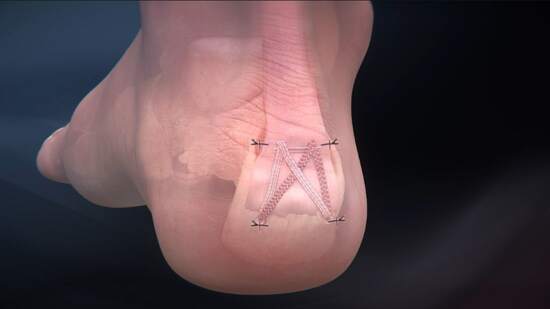 Achilles Tendinitis: Bone Spur Removal and Minimally Invasive Achilles ...