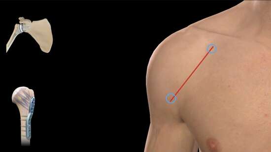 Upper Arm Bone Fractures (Proximal Humerus Fractures): Treatment ...