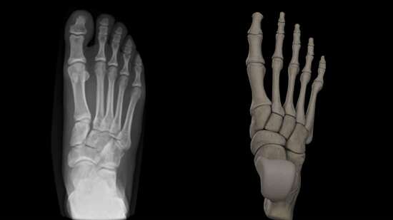 Big Toe Arthritis: Overview : OrthoPedia Patient