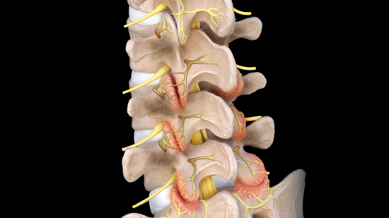 Spinal Arthritis : OrthoPedia