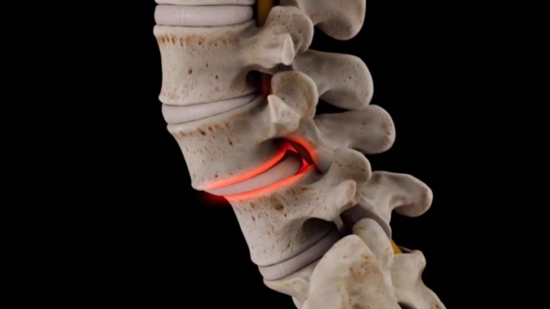 Spinal Instability : OrthoPedia