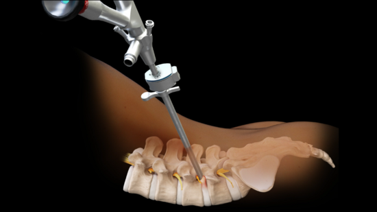 Endoscopic Spine Surgery : OrthoPedia